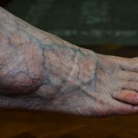 Bulging or Popping Veins: Causes & Treatments